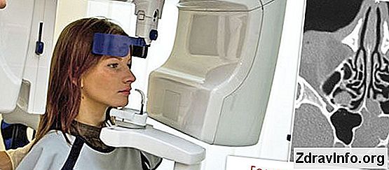 Glava boli, ali lahko sphenoiditis? 👃 Portal Sinusov In Drugi. - 2025