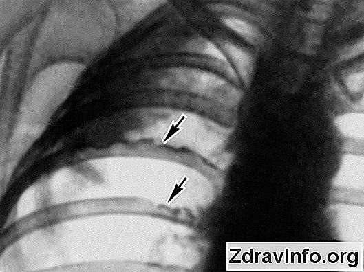 Exsudativní pleurální výpotek: symptomů, etiologie, léčba 👃 Portál ...
