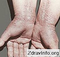 Neurodermatitida - léčba lidovými léky 👃 Portál Sinus A Další. - 2025