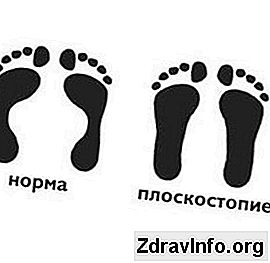 Jak identifikovat a léčit ploché nohy? 👃 Portál Sinus A Další. - 2025
