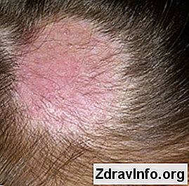 Jak léčit dermatomykózu 👃 Portál Sinus A Další. - 2025