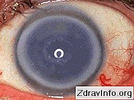 Kornea distrofisi nedir? Hastalık tedavi edilebilir mi? 👃 Portal Sinüs ...