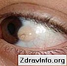 Jaké jsou nebezpečí spojivkových očních cyst? Efektivní léčba patologie ...