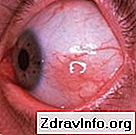 Jaké jsou nebezpečí spojivkových očních cyst? Efektivní léčba patologie ...