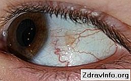Jaké jsou nebezpečí spojivkových očních cyst? Efektivní léčba patologie ...