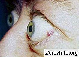 Co je endokrinní oftalmopatie, její příznaky a léčebné metody 👃 Portál ...