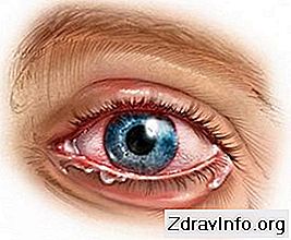 Üveit nedir? Göz hastalığının halk ilaçları ve ilaçlarla tedavisi 👃 ...